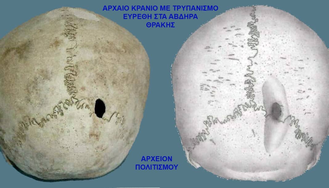 Χειρουργική επέμβαση-τρυπανισμός σε κρανίο γυναίκας, πριν 2.900 χρόνια ...